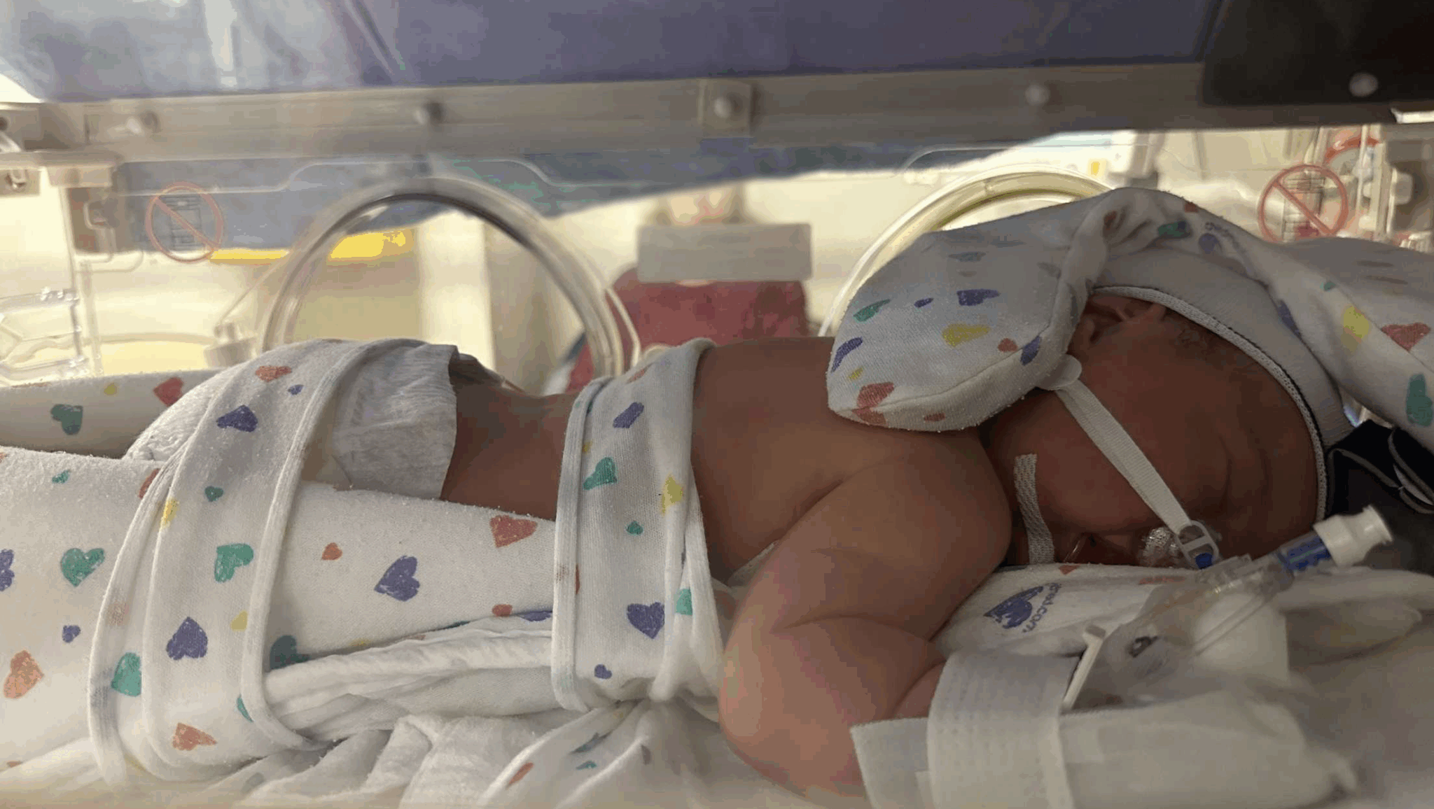 Maeve's Whirlwind Rare Disease Journey: Pierre Robin Sequence ...